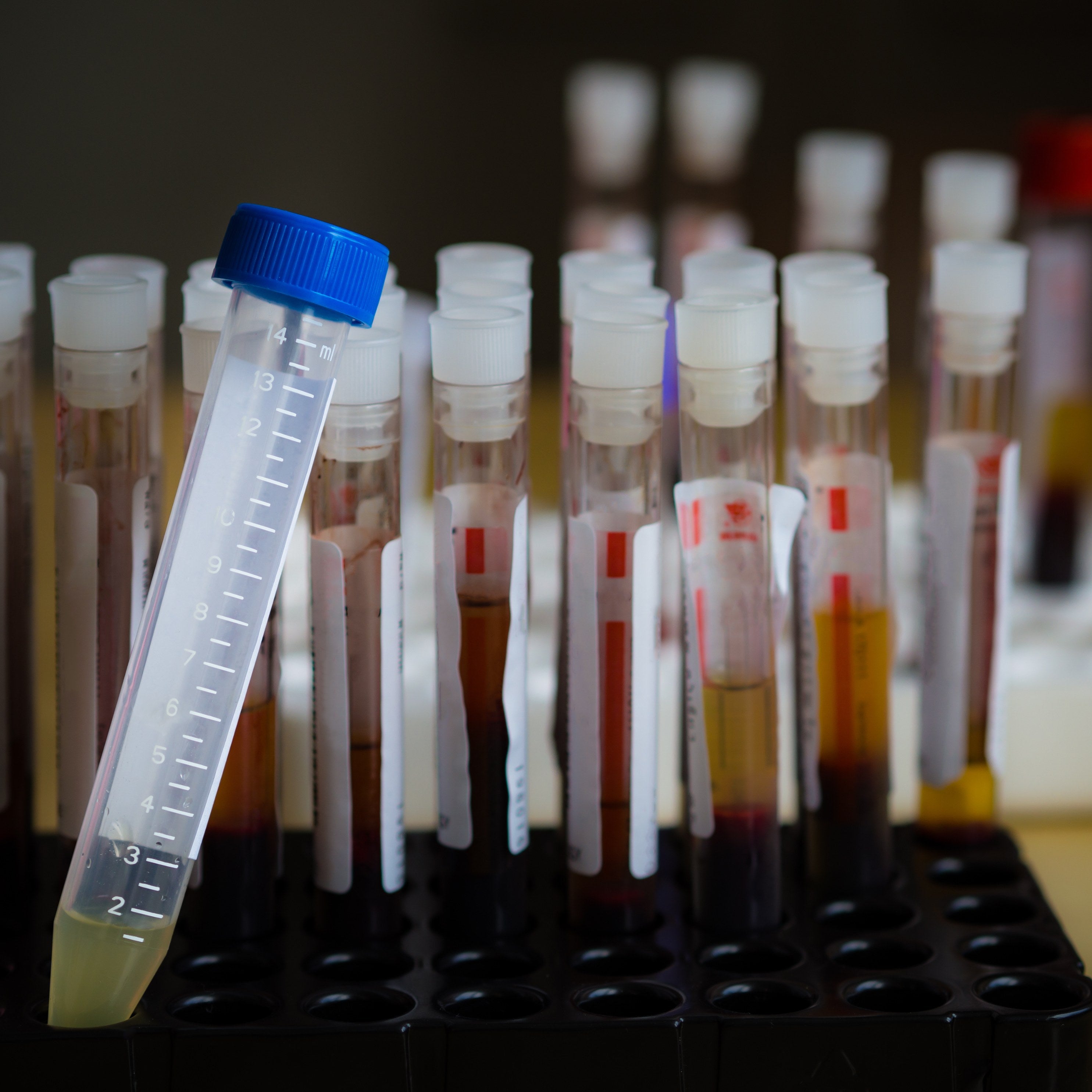 Parkinson's breakthrough: Alpha-synuclein proteins and the gut-brain ...